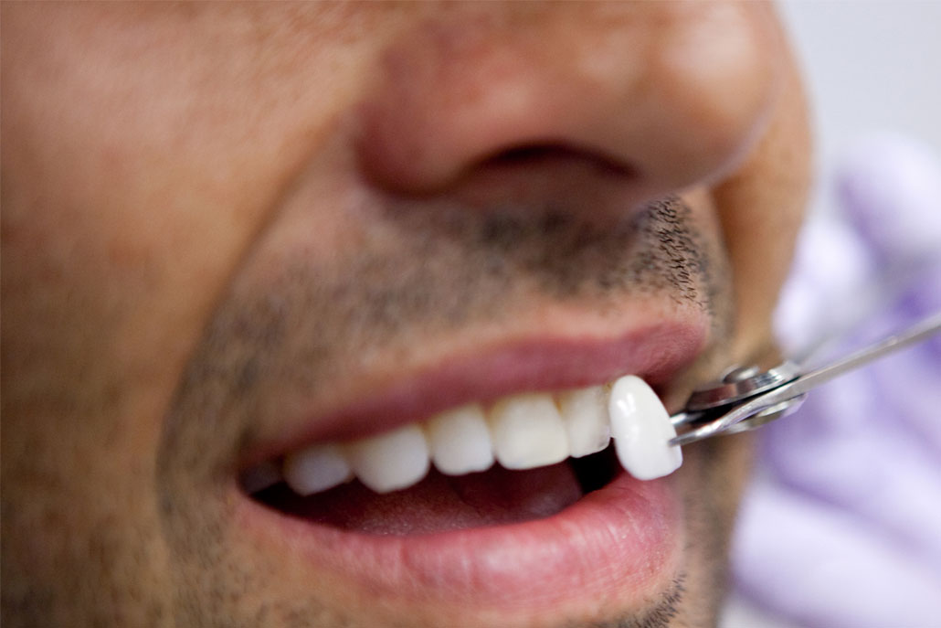Frequently Asked Questions About Veneers - My Dentist News Frequently Asked Questions About Veneers - My Dentist News